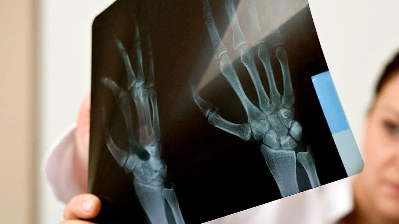 ¿Qué es osteopenia? Causas, síntomas y tratamiento